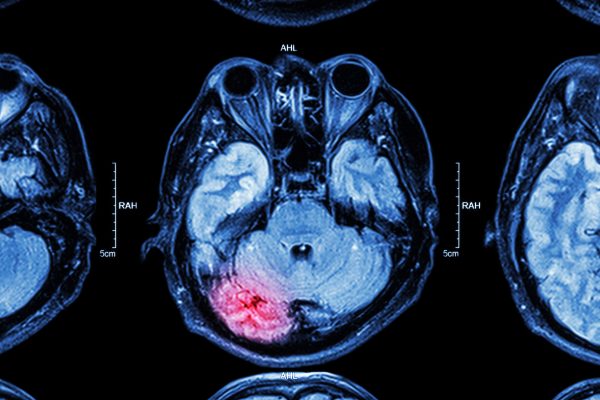 How an MRI Scan Can Detect Problems in Your Brain - Precision MRI