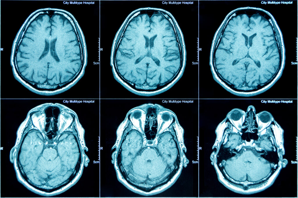 Affordable Brain MRI for Self-Pay Patients: A Complete Guide